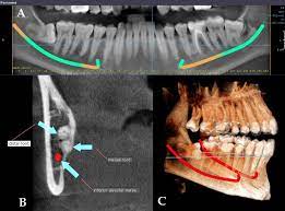 DOES THE CONE BEAM SCAN (CONE BEAM COMPUTED TOMOGRAPHY) CHANGE THE ...